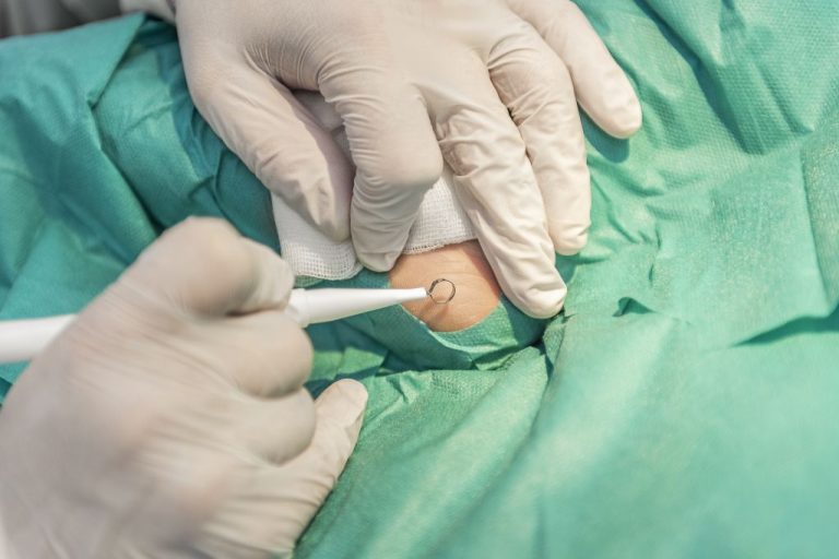 Fusswarzen & Handwarzen sowie 6 Mehtoden zur Warzenbehandlung