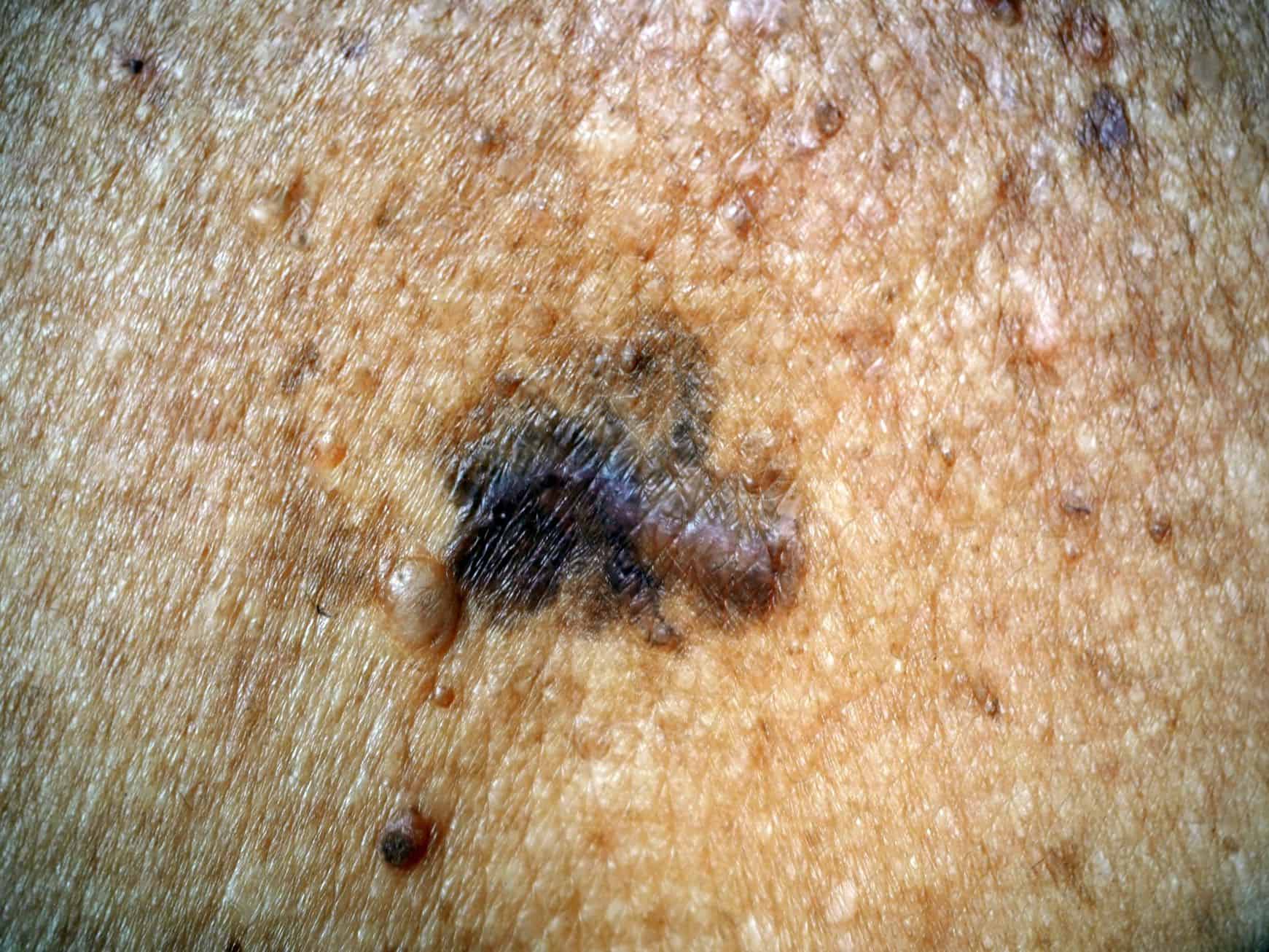 Hautkrebs » Aussehen, Erkennen, Symptome, Vorsorge, Behandlung, Nachsorge