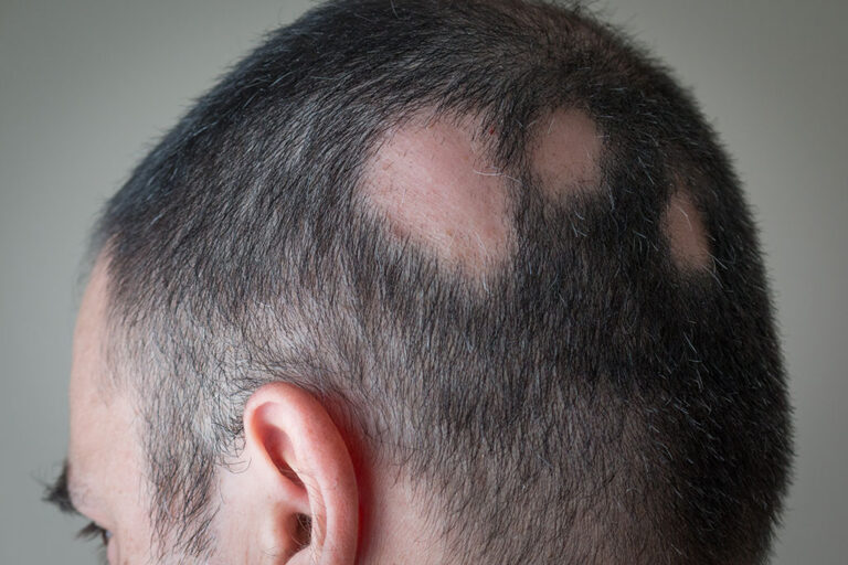 Haarausfall – Ursache, Vorbeugen, Behandeln » derma competence center