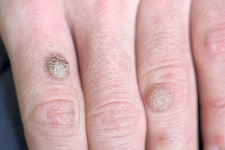 What are Warts & What are the different kinds of Warts? » derma ...