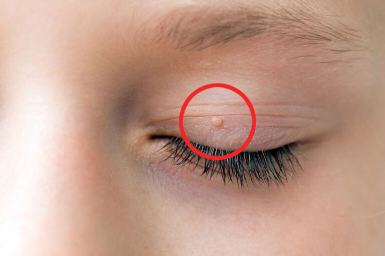 What are Warts & What are the different kinds of Warts? » derma ...