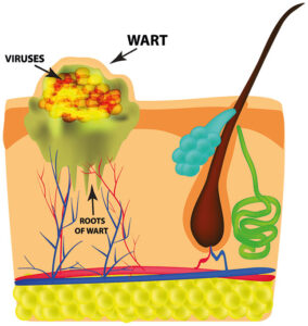 Warzen im Allgemeinen - Wo, Wie & Welche Warzen gibt es?